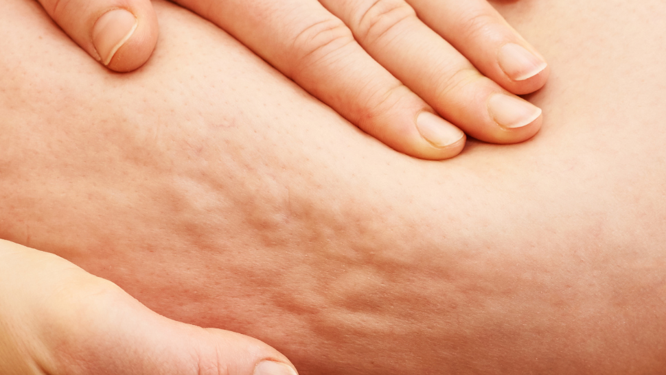 Lipedema: diagnóstico, sintomas e tratamentos